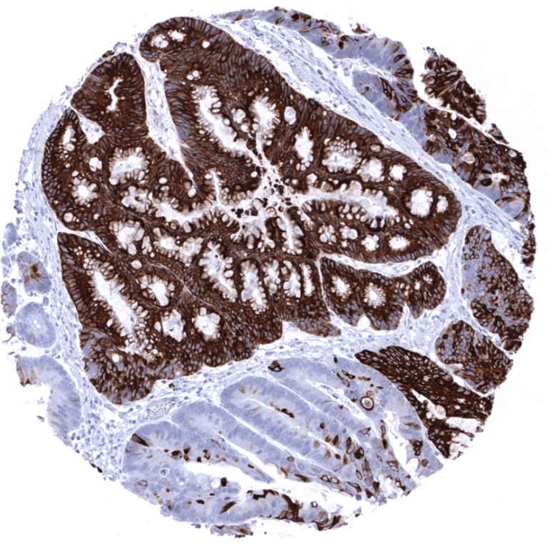 Cancer Tissue Gallery MUC5AC - MS Validated Antibodies