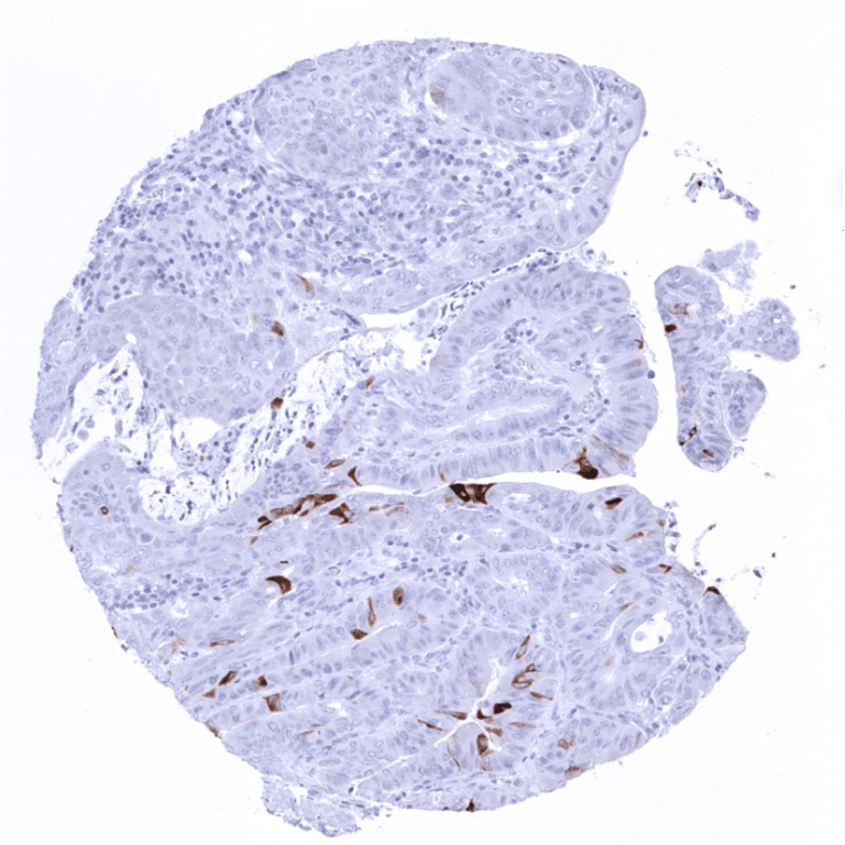 Cancer Tissue Gallery MUC5AC - MS Validated Antibodies