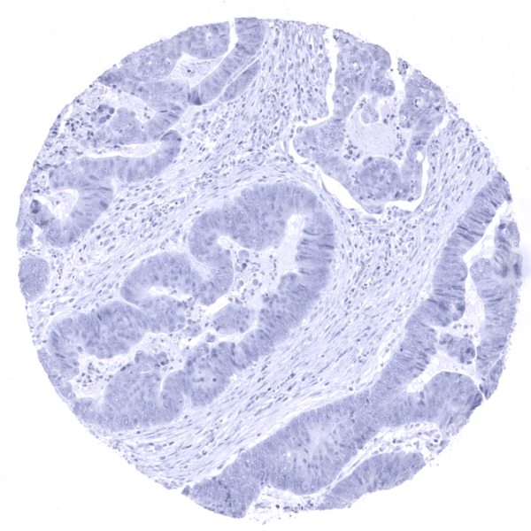 Cancer Tissue Gallery MUC5AC - MS Validated Antibodies