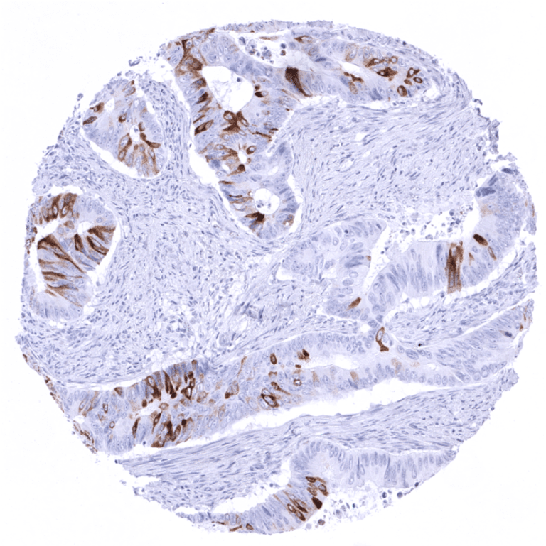 Cancer Tissue Gallery MUC5AC - MS Validated Antibodies