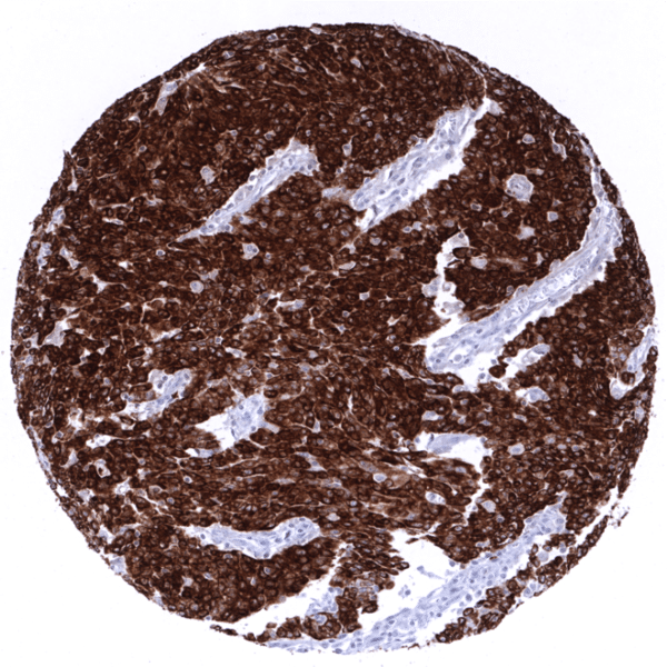 Cancer Tissue Gallery MUC5AC - MS Validated Antibodies