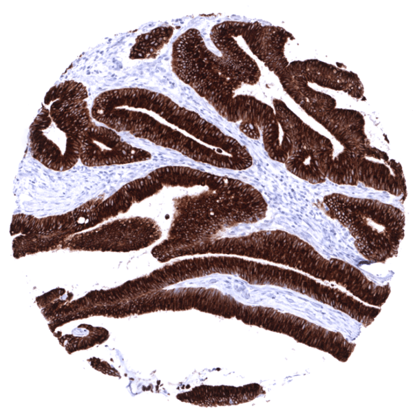 Cancer Tissue Gallery MUC5AC - MS Validated Antibodies