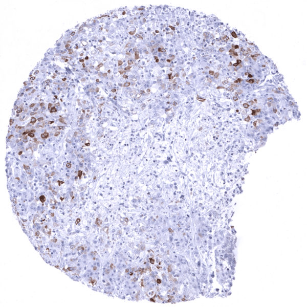 Cancer Tissue Gallery MUC5AC - MS Validated Antibodies