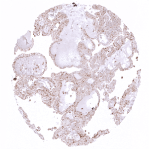 Cancer Tissue Gallery Napsin A - MS Validated Antibodies