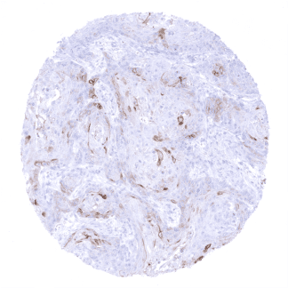 Cancer Tissue Gallery Mesothelin - MS Validated Antibodies