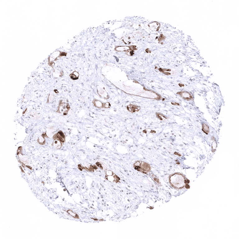 Cancer Tissue Gallery Mesothelin - MS Validated Antibodies