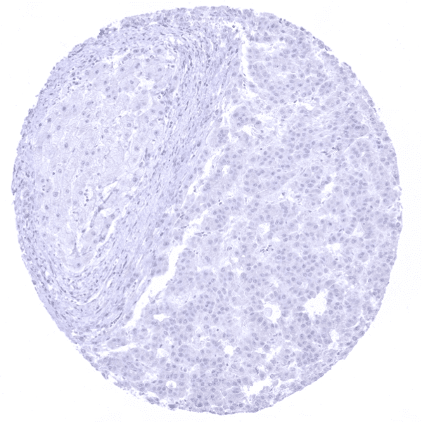 Cancer Tissue Gallery Napsin A - MS Validated Antibodies