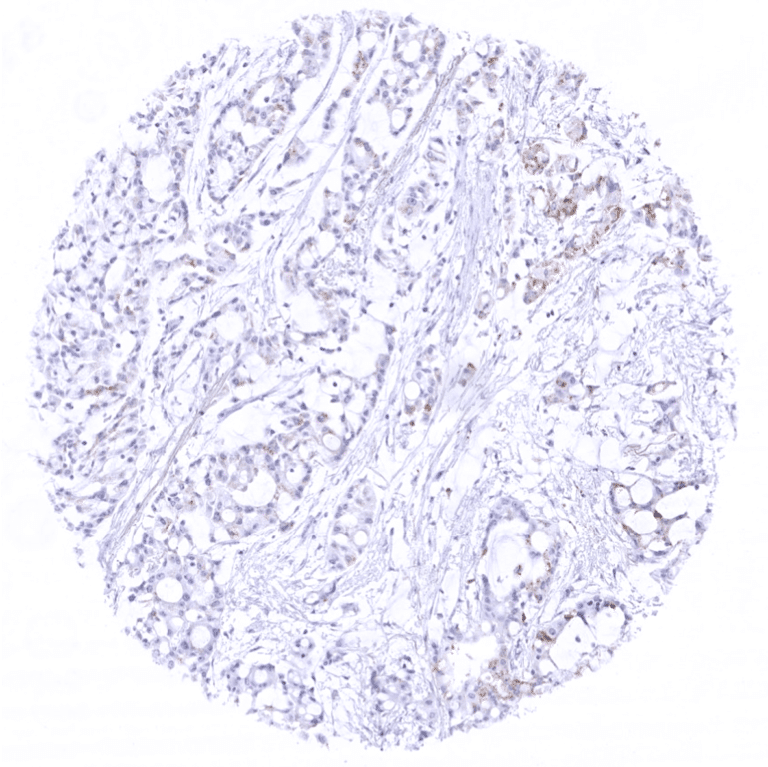 Cancer Tissue Gallery Napsin A - MS Validated Antibodies