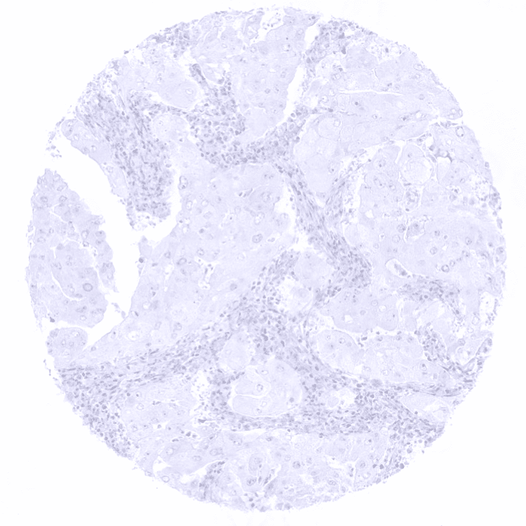 Cancer Tissue Gallery Napsin A - MS Validated Antibodies