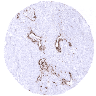 Cancer Tissue Gallery Napsin A - MS Validated Antibodies