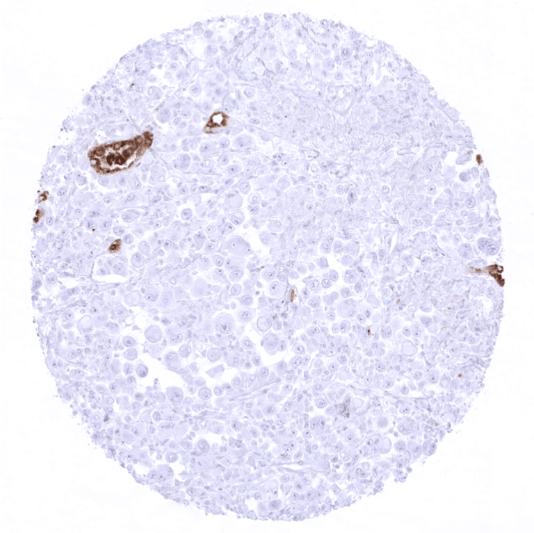Cancer Tissue Gallery Napsin A - MS Validated Antibodies