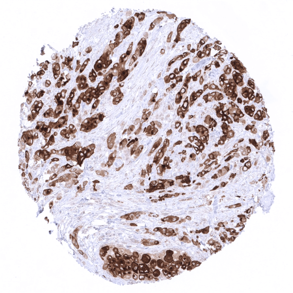 Cancer Tissue Gallery Mesothelin - MS Validated Antibodies