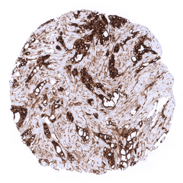 Cancer Tissue Gallery Mesothelin - MS Validated Antibodies