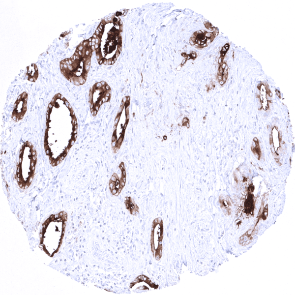 Cancer Tissue Gallery CEA - MS Validated Antibodies