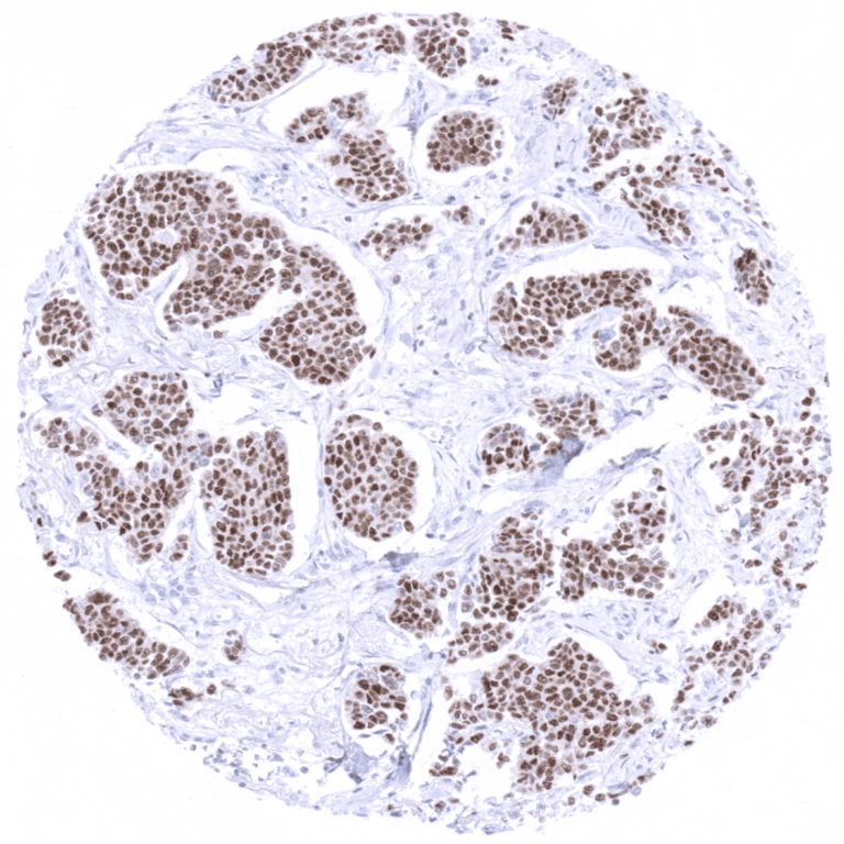 Cancer Tissue Gallery GATA3 - MS Validated Antibodies