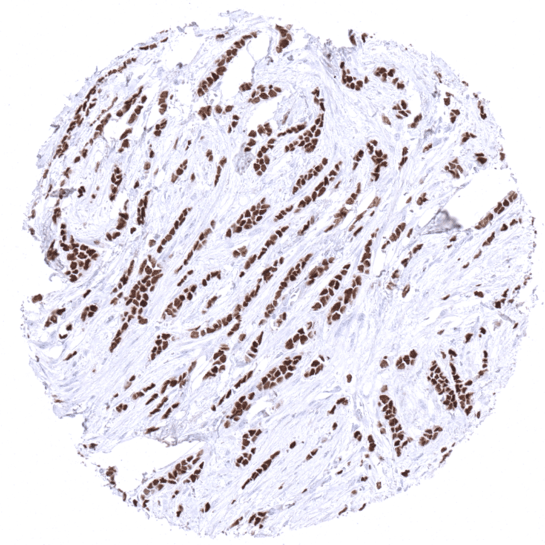 Cancer Tissue Gallery GATA3 - MS Validated Antibodies
