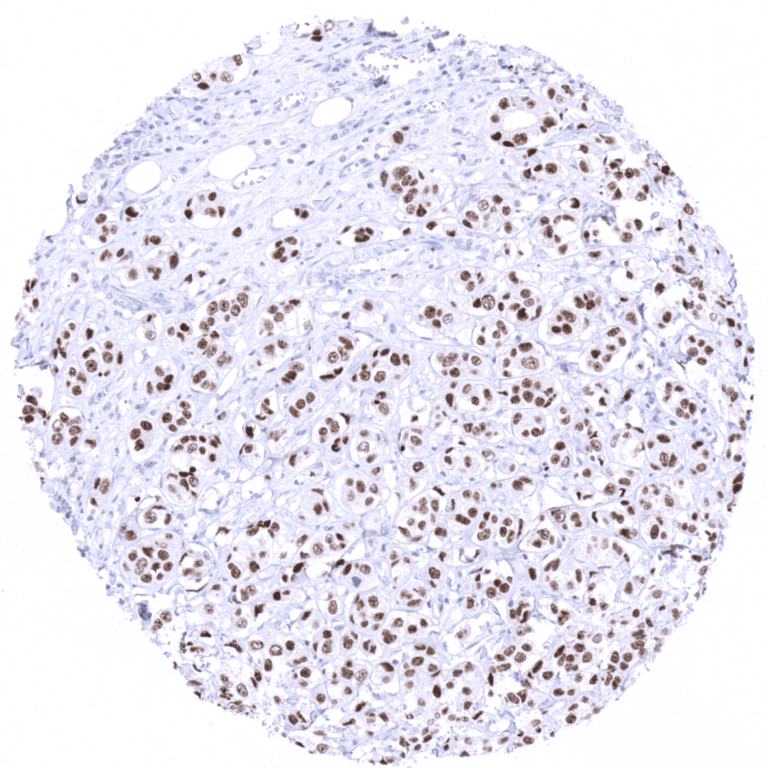 Cancer Tissue Gallery GATA3 - MS Validated Antibodies