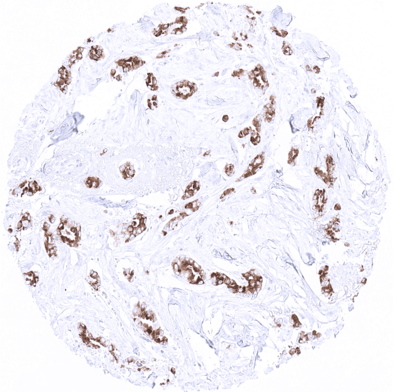 Cancer Tissue Gallery MUC6 - MS Validated Antibodies