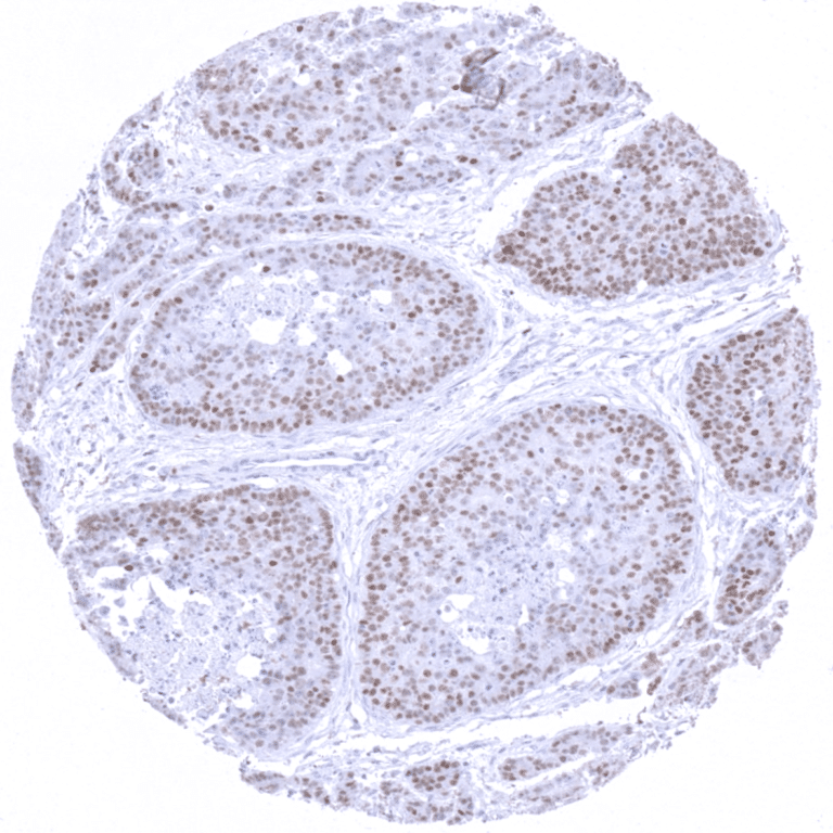 Cancer Tissue Gallery GATA3 - MS Validated Antibodies