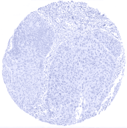 Cancer Tissue Gallery MUC6 - MS Validated Antibodies