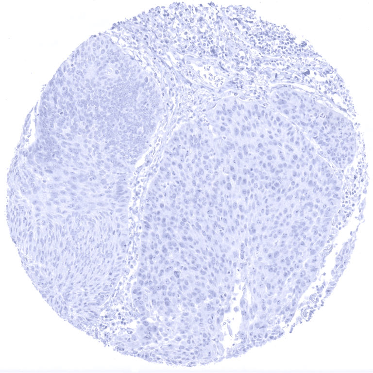 Cancer Tissue Gallery MUC6 - MS Validated Antibodies
