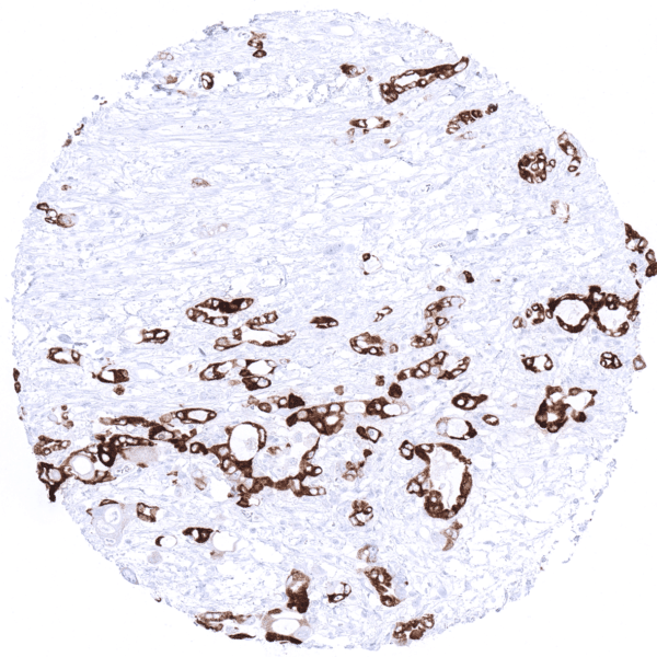 Cancer Tissue Gallery MUC6 - MS Validated Antibodies