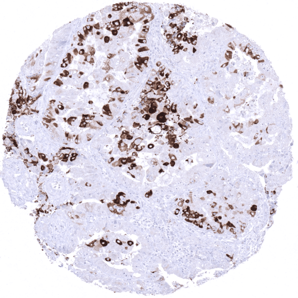 Cancer Tissue Gallery MUC6 - MS Validated Antibodies