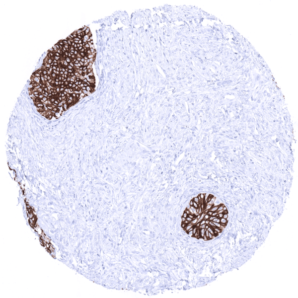 Cancer Tissue Gallery Cytokeratin 13 - MS Validated Antibodies