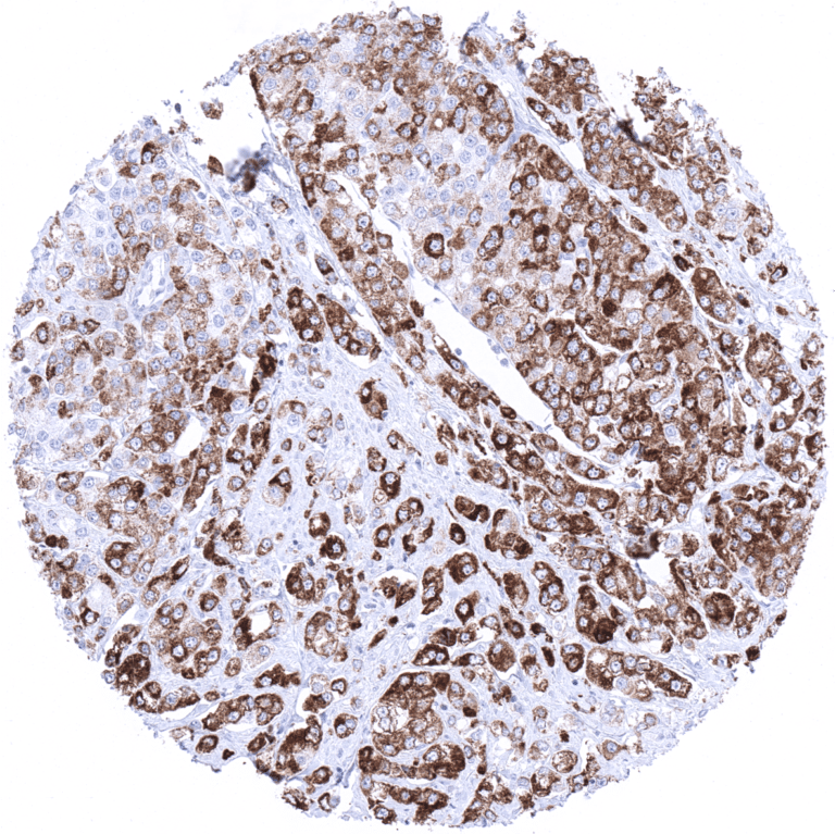 Cancer Tissue Gallery MUC6 - MS Validated Antibodies