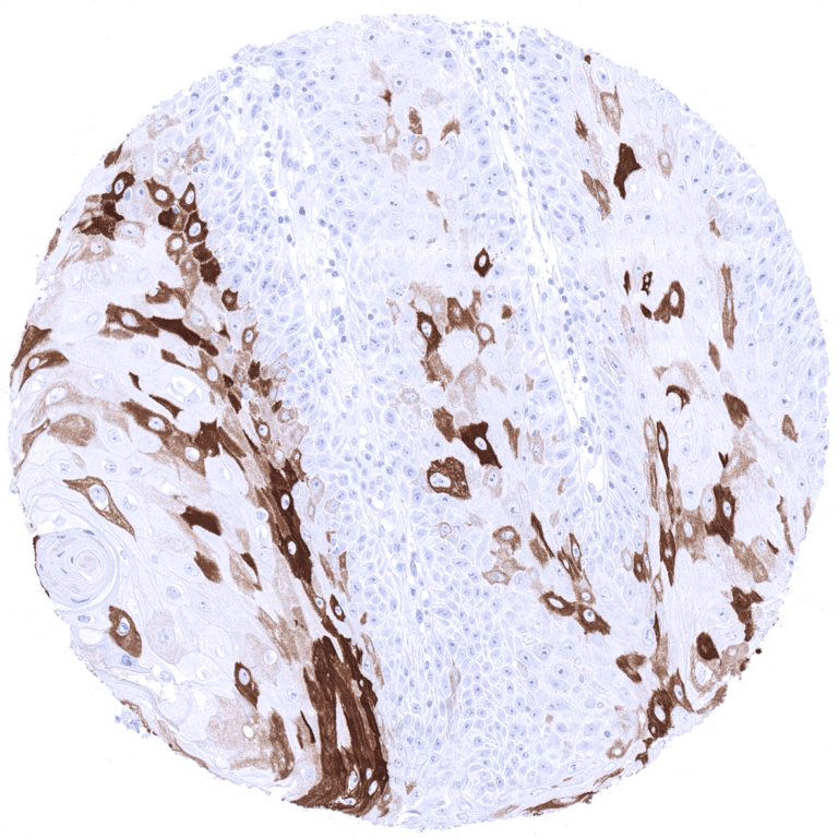 Cancer Tissue Gallery Cytokeratin 13 - MS Validated Antibodies
