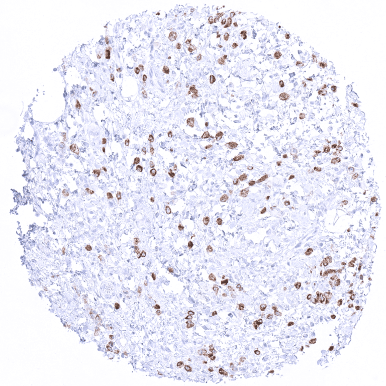 Cancer Tissue Gallery MUC6 - MS Validated Antibodies