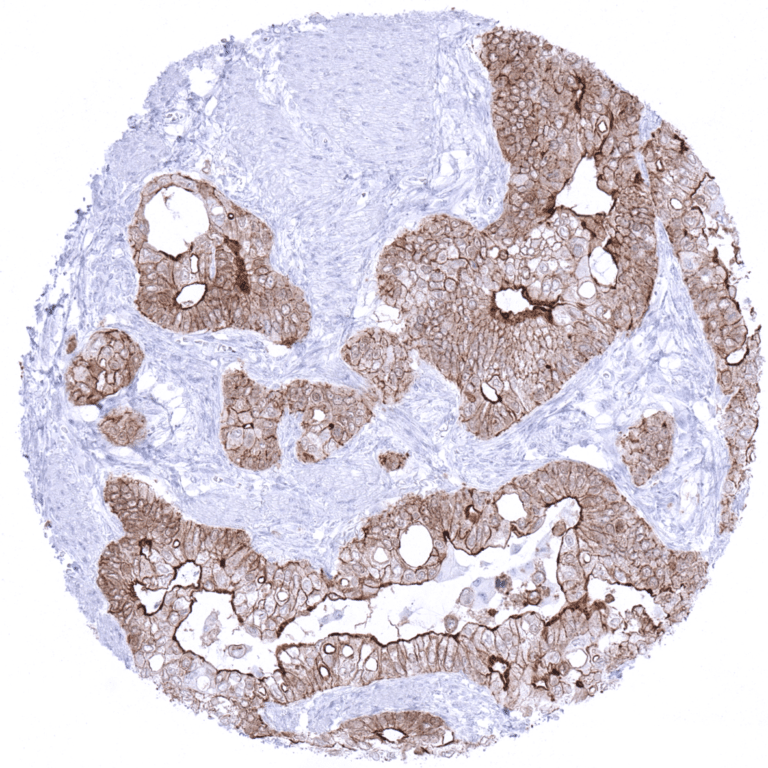 Cancer Tissue Gallery Villin - MS Validated Antibodies