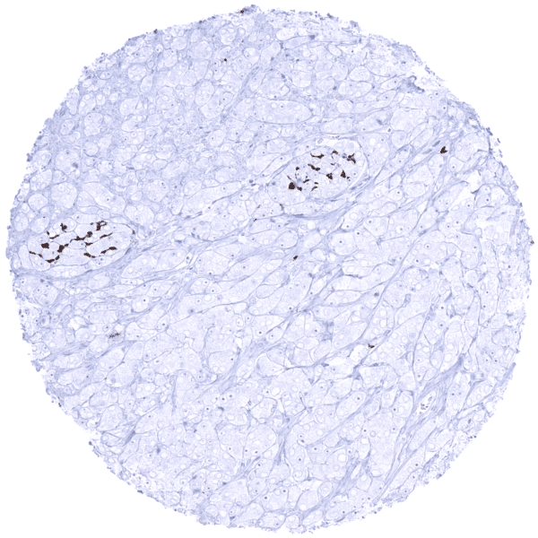 Cancer Tissue Gallery S100 - MS Validated Antibodies