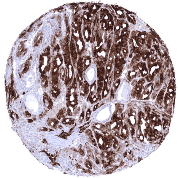 Cancer Tissue Gallery S100 - MS Validated Antibodies