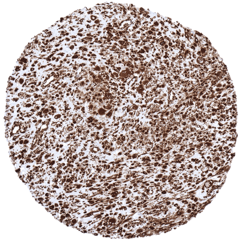 Cancer Tissue Gallery Vimentin - MS Validated Antibodies