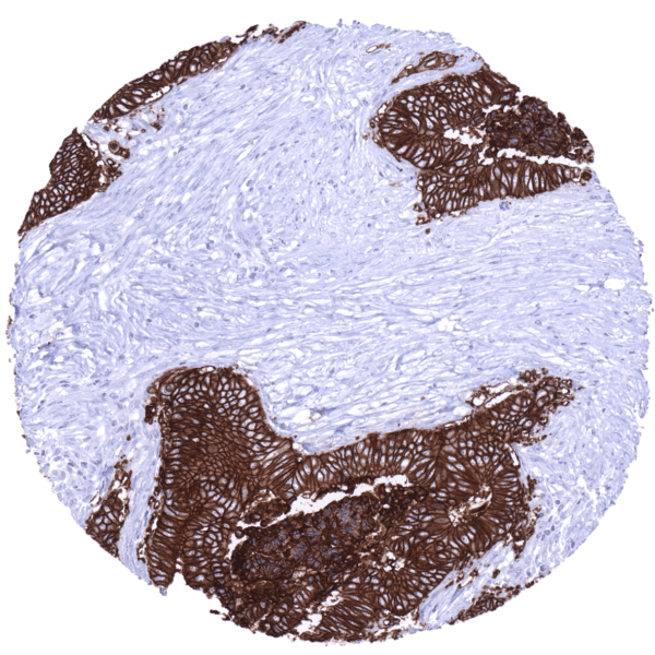 Cancer Tissue Gallery EpCam - MS Validated Antibodies