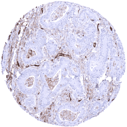 Cancer Tissue Gallery CD31 - MS Validated Antibodies