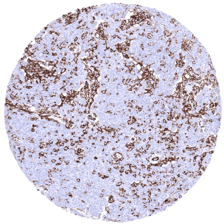 Cancer Tissue Gallery CD31 - MS Validated Antibodies