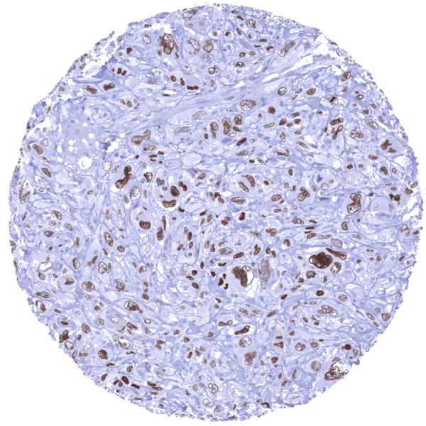 Cancer Tissue Gallery SATB2 - MS Validated Antibodies