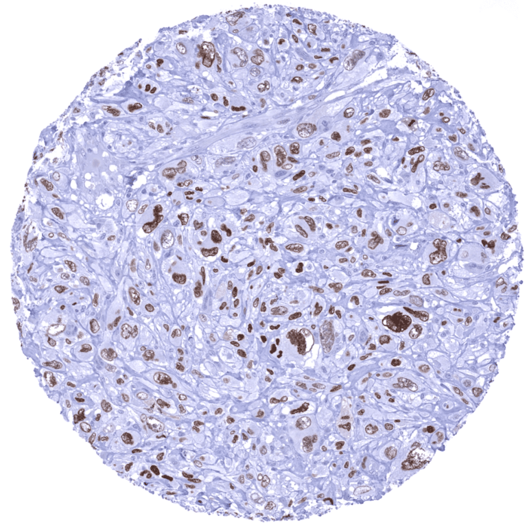 Cancer Tissue Gallery SATB2 - MS Validated Antibodies