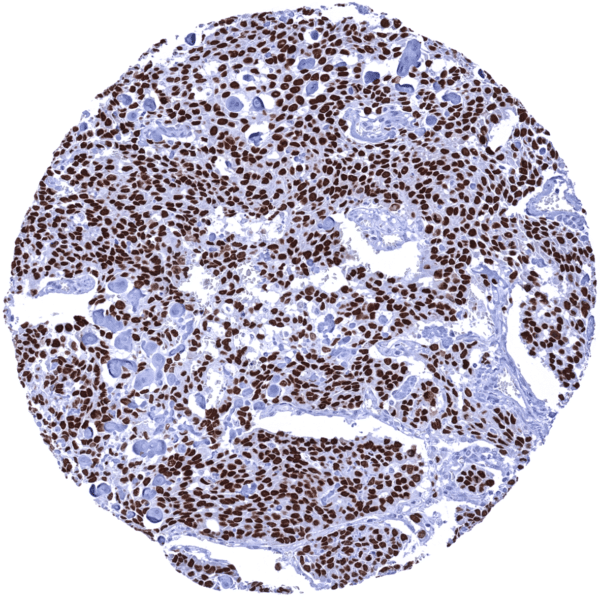 Cancer Tissue Gallery SATB2 - MS Validated Antibodies
