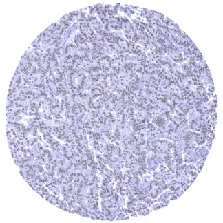 Cancer Tissue Gallery SATB2 - MS Validated Antibodies