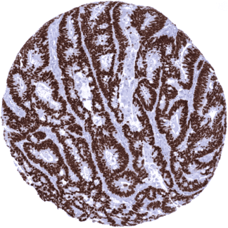 Cancer Tissue Gallery SATB2 - MS Validated Antibodies