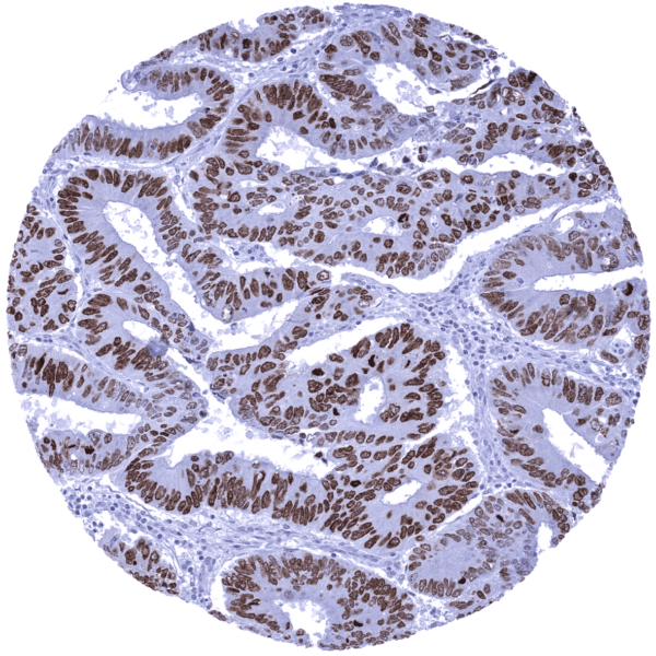 Cancer Tissue Gallery SATB2 - MS Validated Antibodies