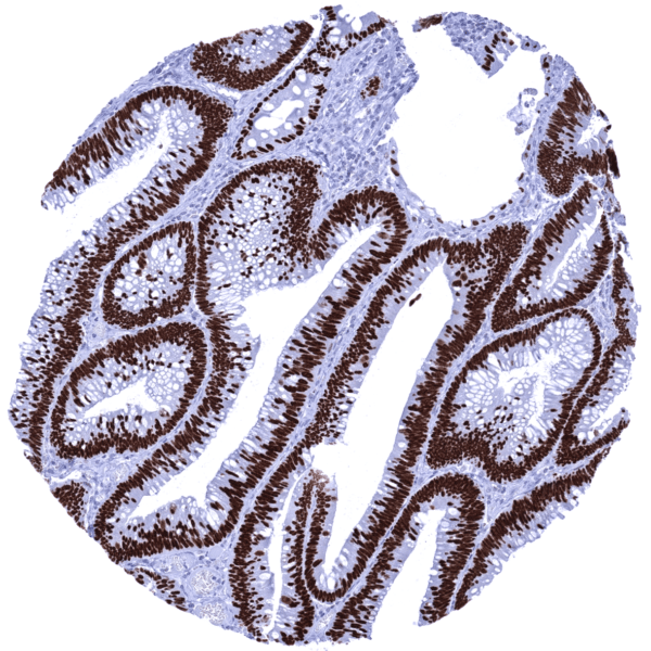 Cancer Tissue Gallery SATB2 - MS Validated Antibodies