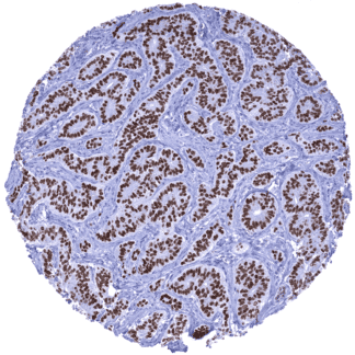 Cancer Tissue Gallery SATB2 - MS Validated Antibodies