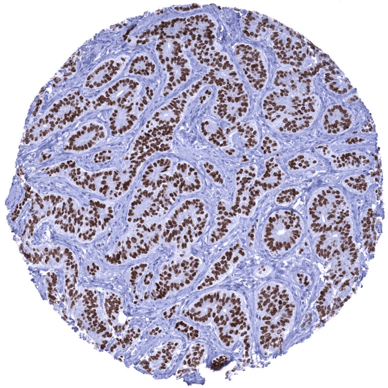 Cancer Tissue Gallery SATB2 - MS Validated Antibodies