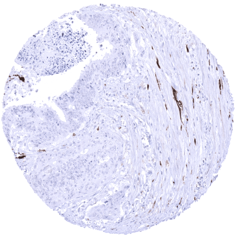 Cancer Tissue Gallery PGP9.5 / UCHL1 - MS Validated Antibodies