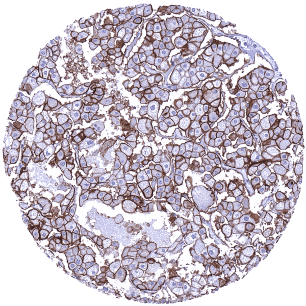 Cancer Tissue Gallery TACSTD2 / Trop-2 - MS Validated Antibodies