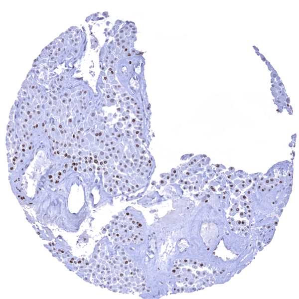 Cancer Tissue Gallery SATB2 - MS Validated Antibodies